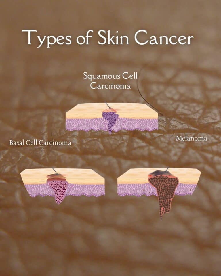 How to Spot Skin Cancer? - Gay Friendly