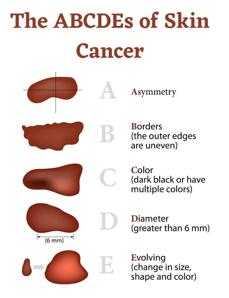 How to Spot Skin Cancer? - Gay Friendly